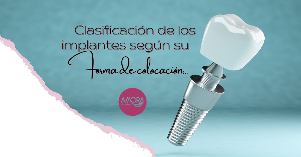 Clasificación de los implantes dentales según su forma de colocación